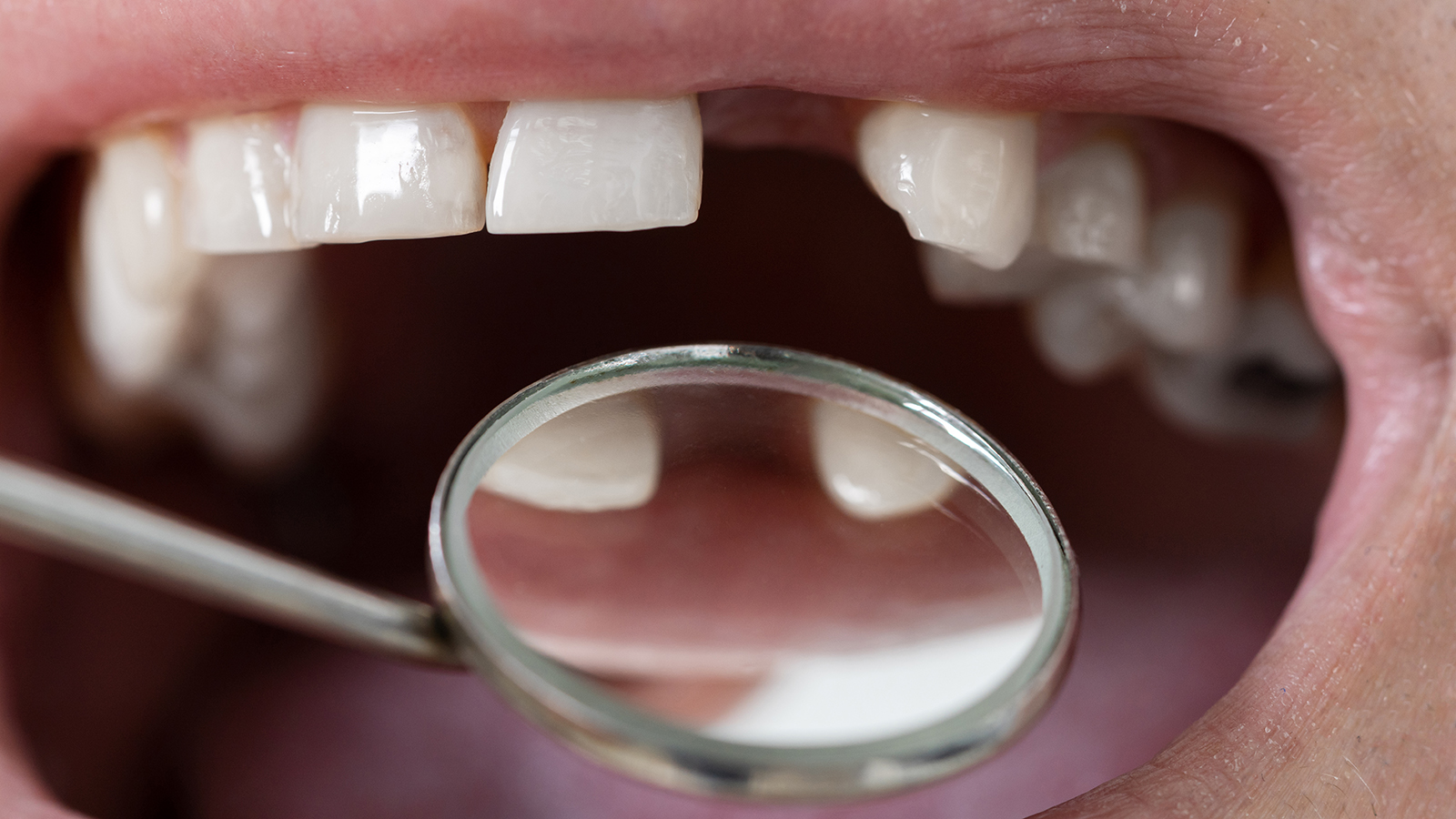 The Management of Adjacent Missing Teeth in the Esthetic Zone | Courses ...