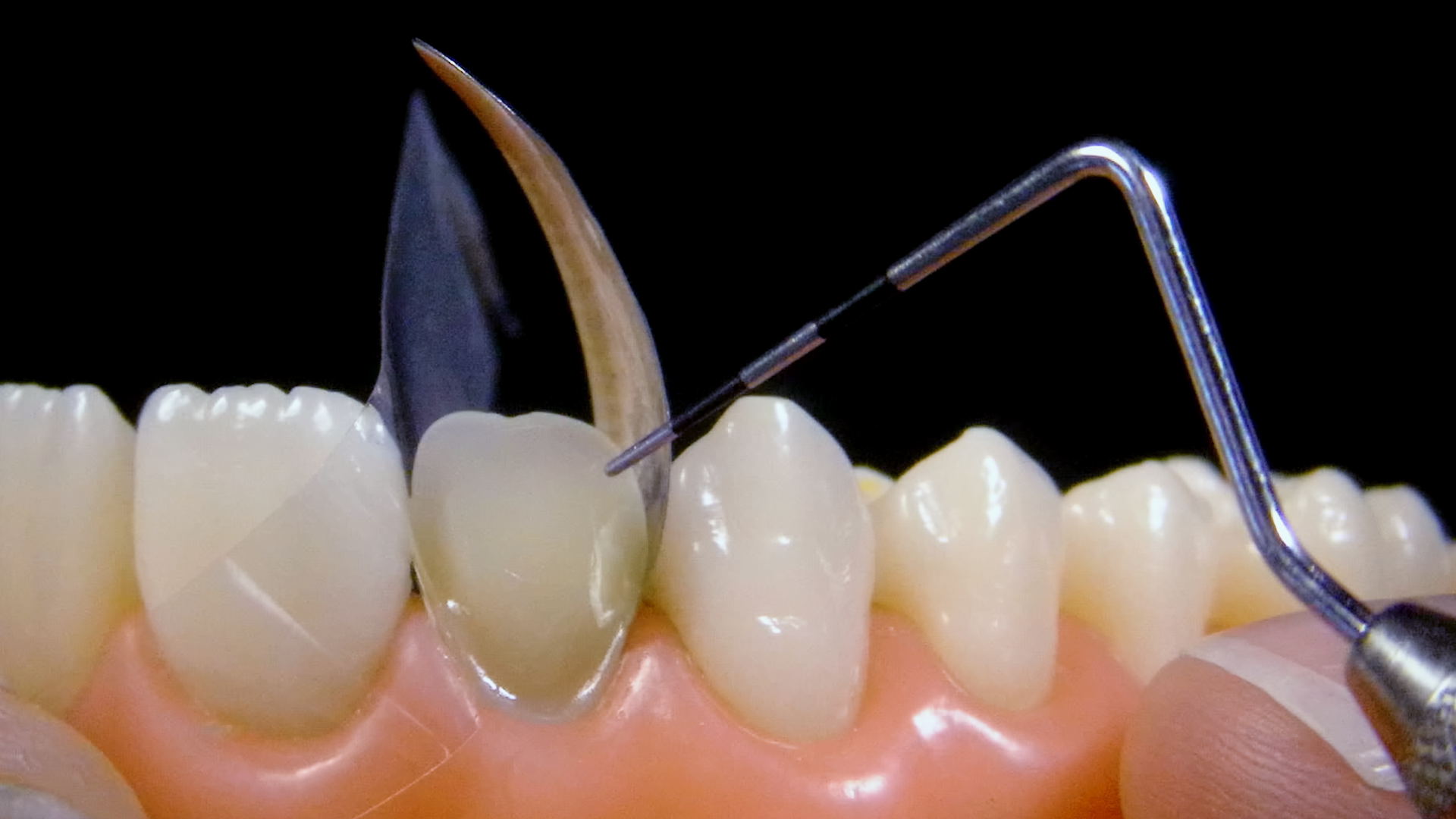 Discolored Lateral Incisor: Prep, Matrixing, and Bonding | Spear Education