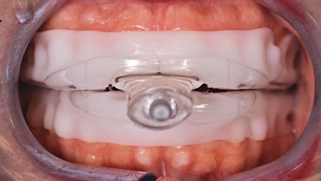 Seattle Protocol Step 5: Dual Arch Anterior Repositioning Splint ...