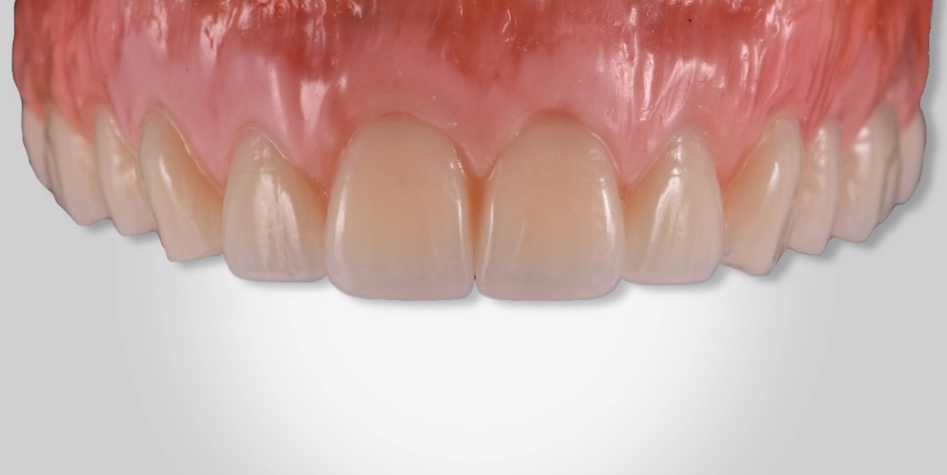 Treating the Edentulous Arches and Introducing the LTR Classification ...