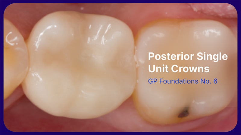 Posterior Single Unit Crowns — GP Foundations No. 6 | Spear Education