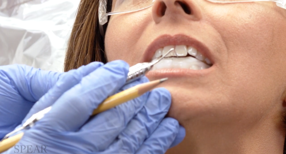 Implementing the Seattle Protocol: A Chairside Demonstration | Spear ...