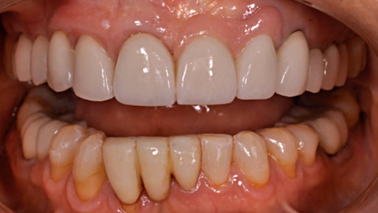 Seattle Protocol Step 3: Mandibular Anterior Repositioning Splint ...