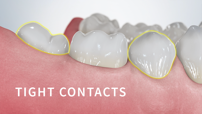 When Interproximal Contacts Are Too Tight During Crown Seating | Spear ...