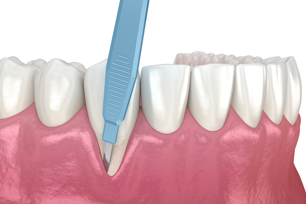 Crown Lengthening - Closed Flap Laser Surgery | Spear Education