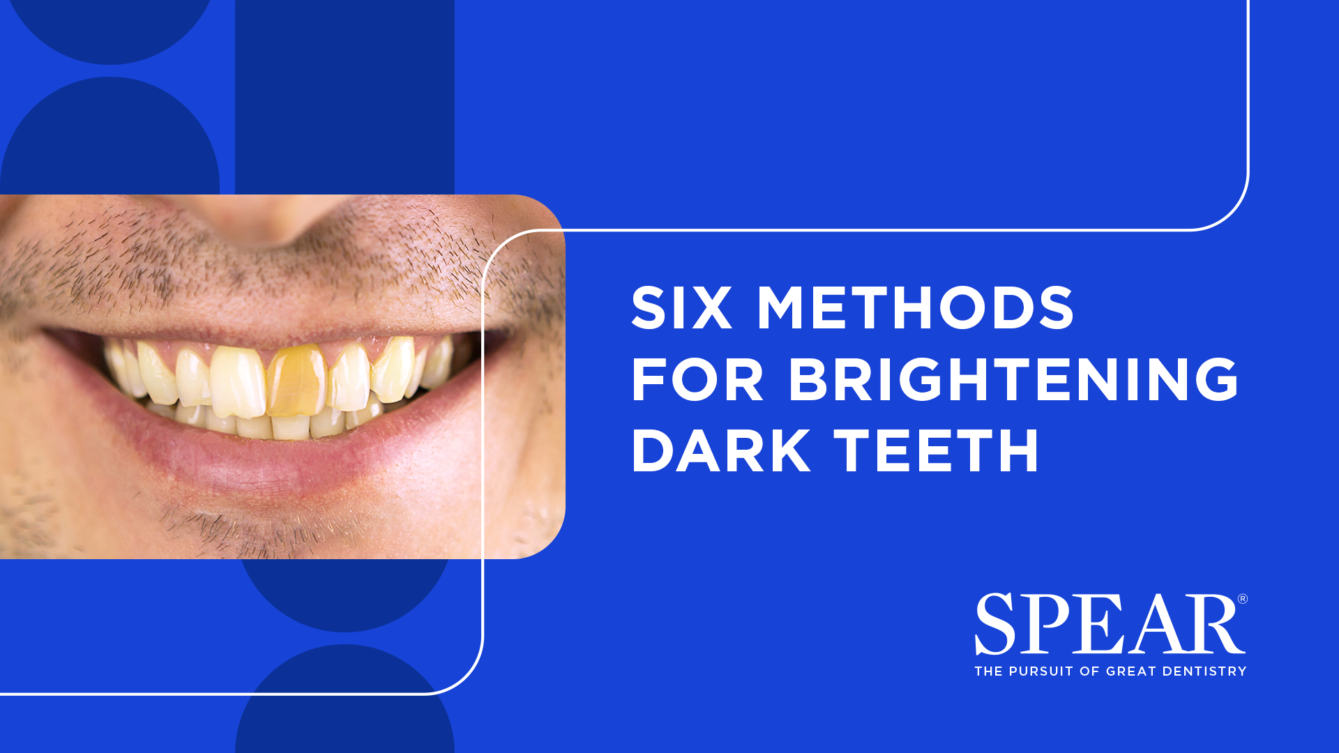 External Vital Single Tooth Bleaching | Spear Education