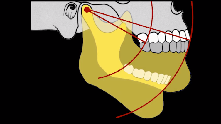Using Models To Evaluate and Treatment Plan Occlusal Issues | Spear ... Using Models To Evaluate and Treatment Plan Occlusal Issues | Spear ...