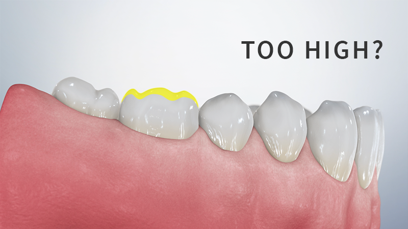 Adjusting a Crown in High Occlusion During Crown Seating | Spear Education