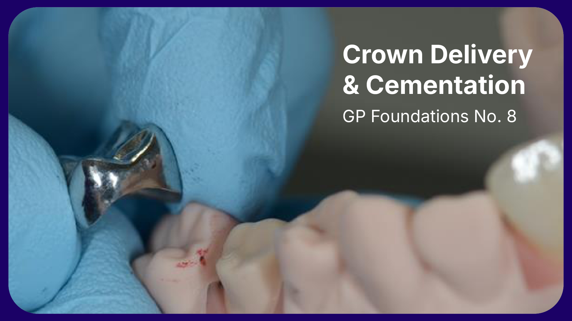Crown Delivery & Cementation — GP Foundations No. 8 | Spear Education