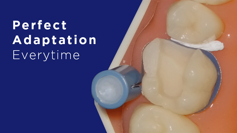 Gingival Margin Elevation | Spear Education