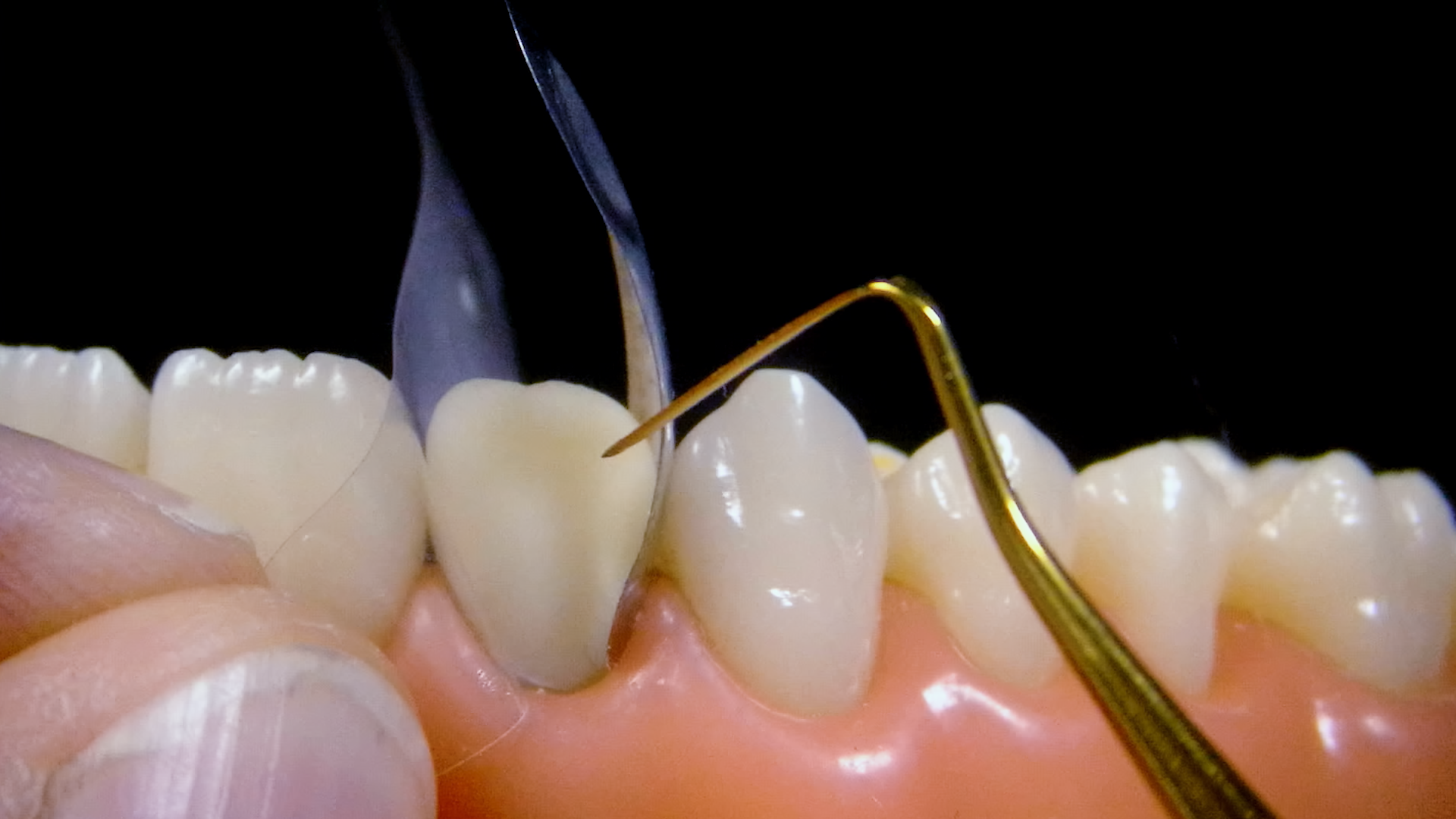 Discolored Lateral Incisor: Dentin Replacement | Spear Education
