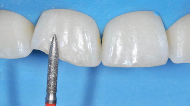 Composite Layering Techniques | Spear Education