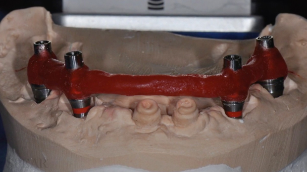 Impression Techniques | Spear Education