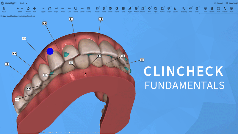 ClinCheck Fundamentals: Maximizing 3D Controls for Invisalign Treatment ...