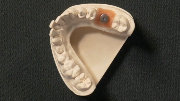 Comparing Closed Tray and Open Tray Impression Copings -Tissue Level ...