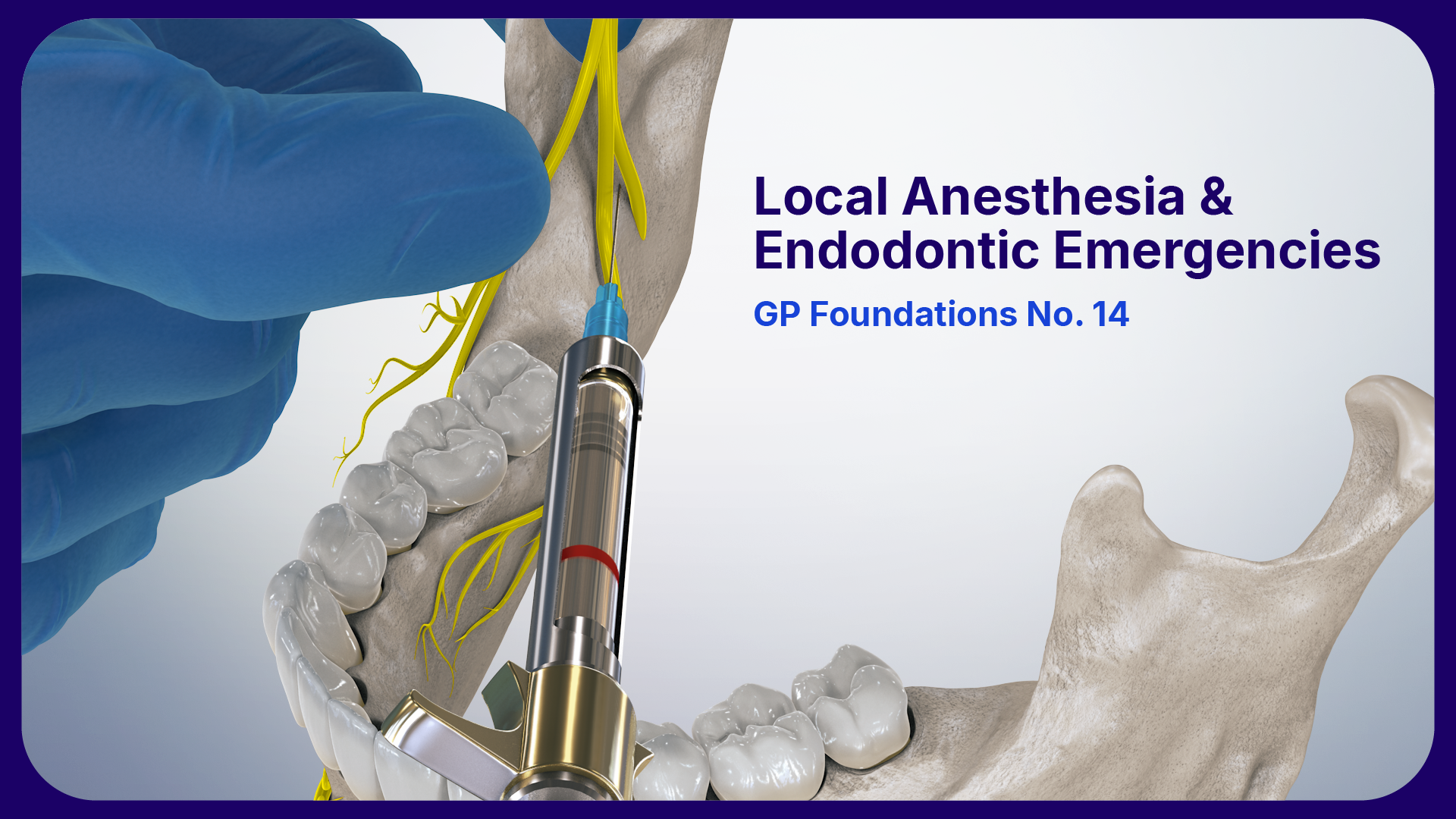 Local Anesthesia & Endodontic Emergencies — GP Foundations No. 14 ...