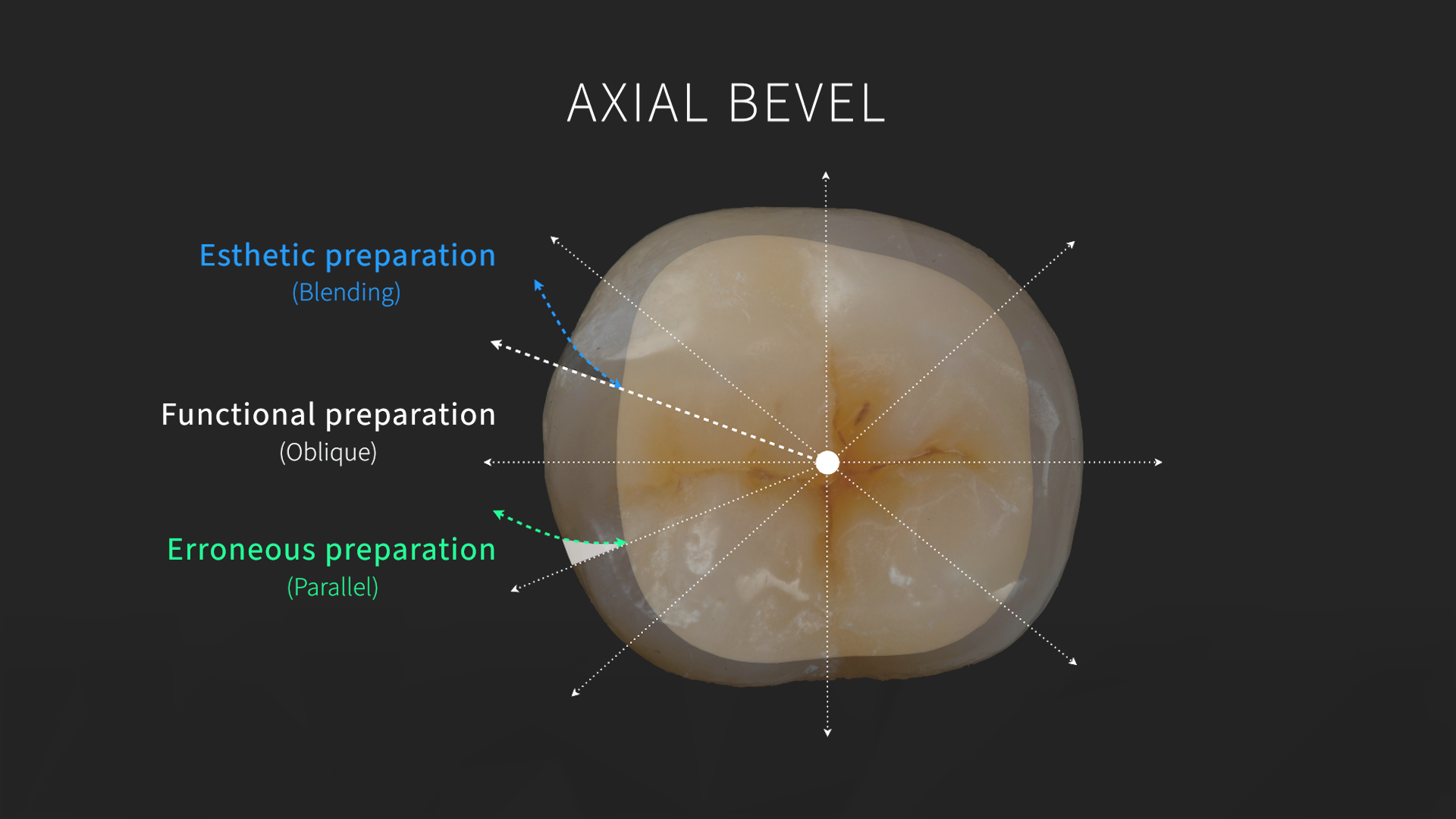 The Class II Box: Preparation Demonstration | Spear Education