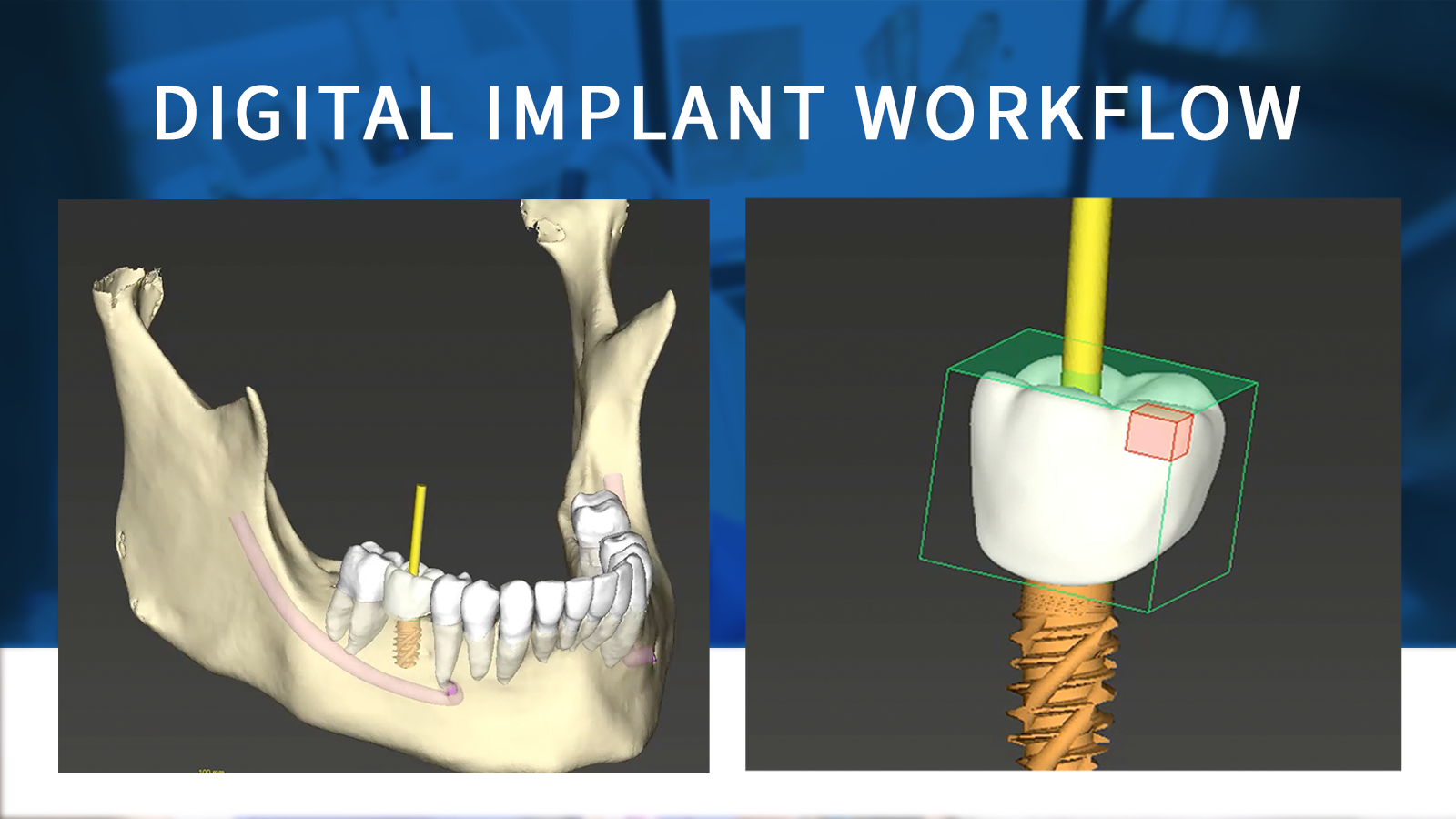 Digital Implant Workflow Basics | Spear Education