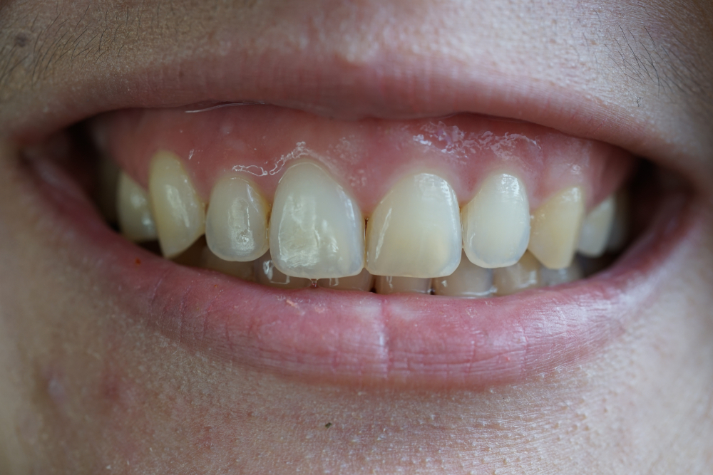 The Gummy Smile - Over Eruption of Anterior Teeth | Spear Education