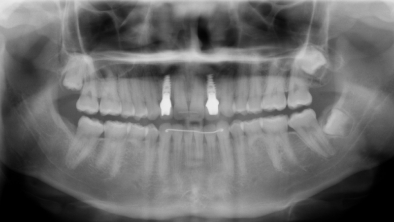 The Orthodontic Implant Interface, Part 1 | Spear Education