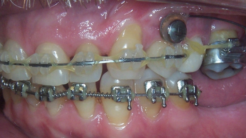 The Orthodontic Implant Interface, Part 2 | Spear Education