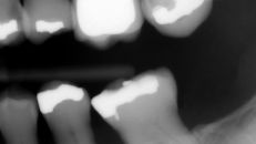 Common Errors in Periapical Radiographs | Spear Education