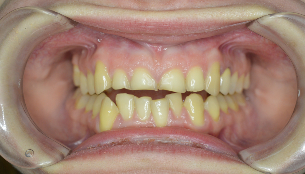 Common Patterns of Tooth Wear and Their Treatment | Spear Education