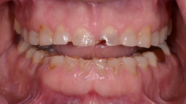 Treating the Worn Dentition | Spear Education